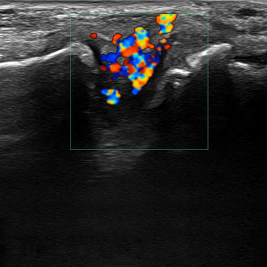 Tibiotalar Joint Effusion - Ultrasound-Guided Injection Training