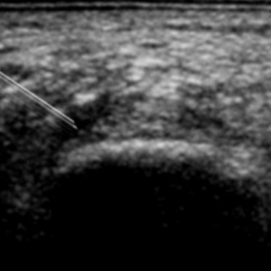 Plantar Fascia Ultrasound-Guided Injections Procedure Module