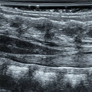 Neonatal Infant Lumbar Puncture Ultrasound Procedure