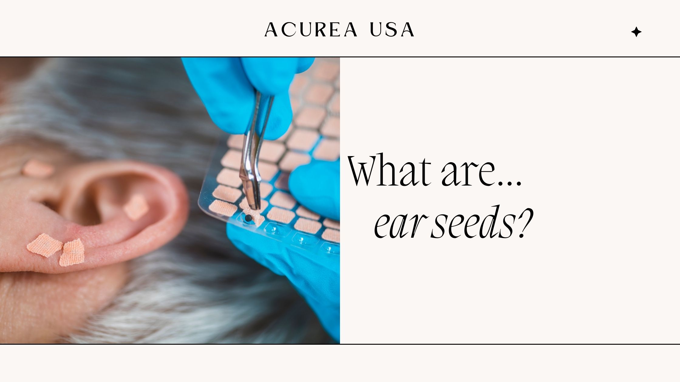 What are Ear Seeds? - Acurea USA