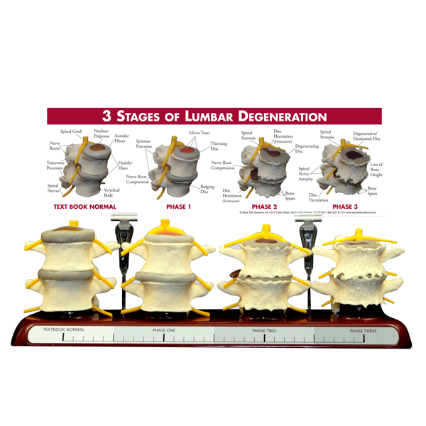 Spinal Degeneration Model | Buy Online
