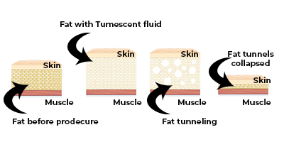 Types of Liposuction Procedures - Exquisite Bodies