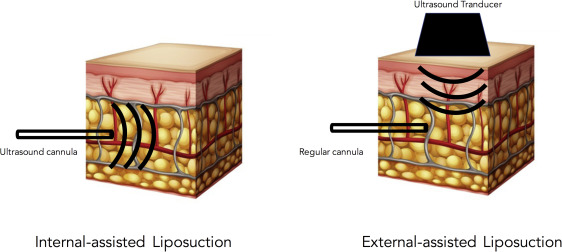 Types of Liposuction Procedures - Exquisite Bodies