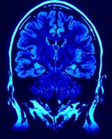 Did a Brain Injury Turn This Man Into a Mathematical Genius ...