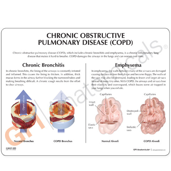 Chronic Obstructive Pulmonary Disease (COPD) Model - Clinical Charts ...