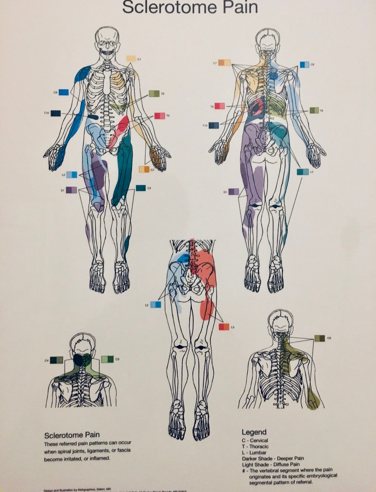 Sclerotome Pain Poster