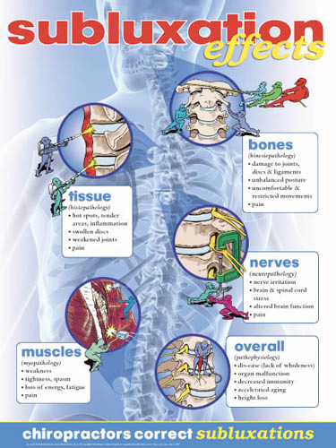 Subluxation Effects Poster - Clinical Charts and Supplies
