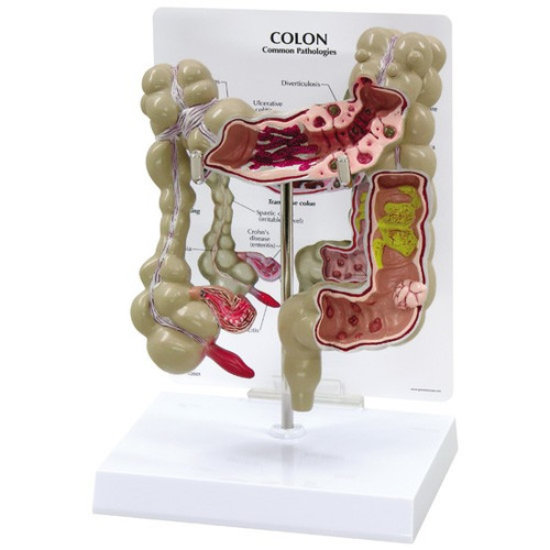 Colon Anatomy Model - Clinical Charts and Supplies