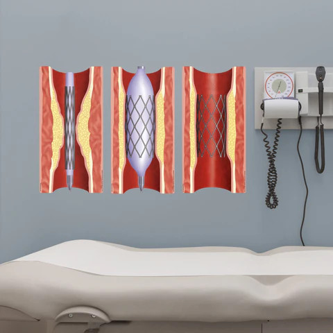Angioplasty Sticky Wall Chart - Clinical Charts and Supplies