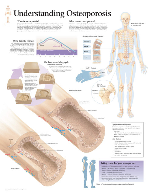 Osteoporosis Anatomy Poster - Clinical Charts and Supplies