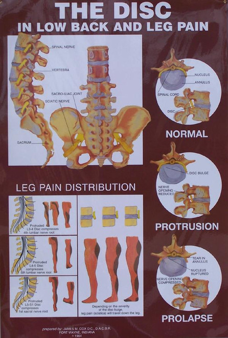 Disc and Vertebrae Anatomical Poster - Clinical Charts and Supplies