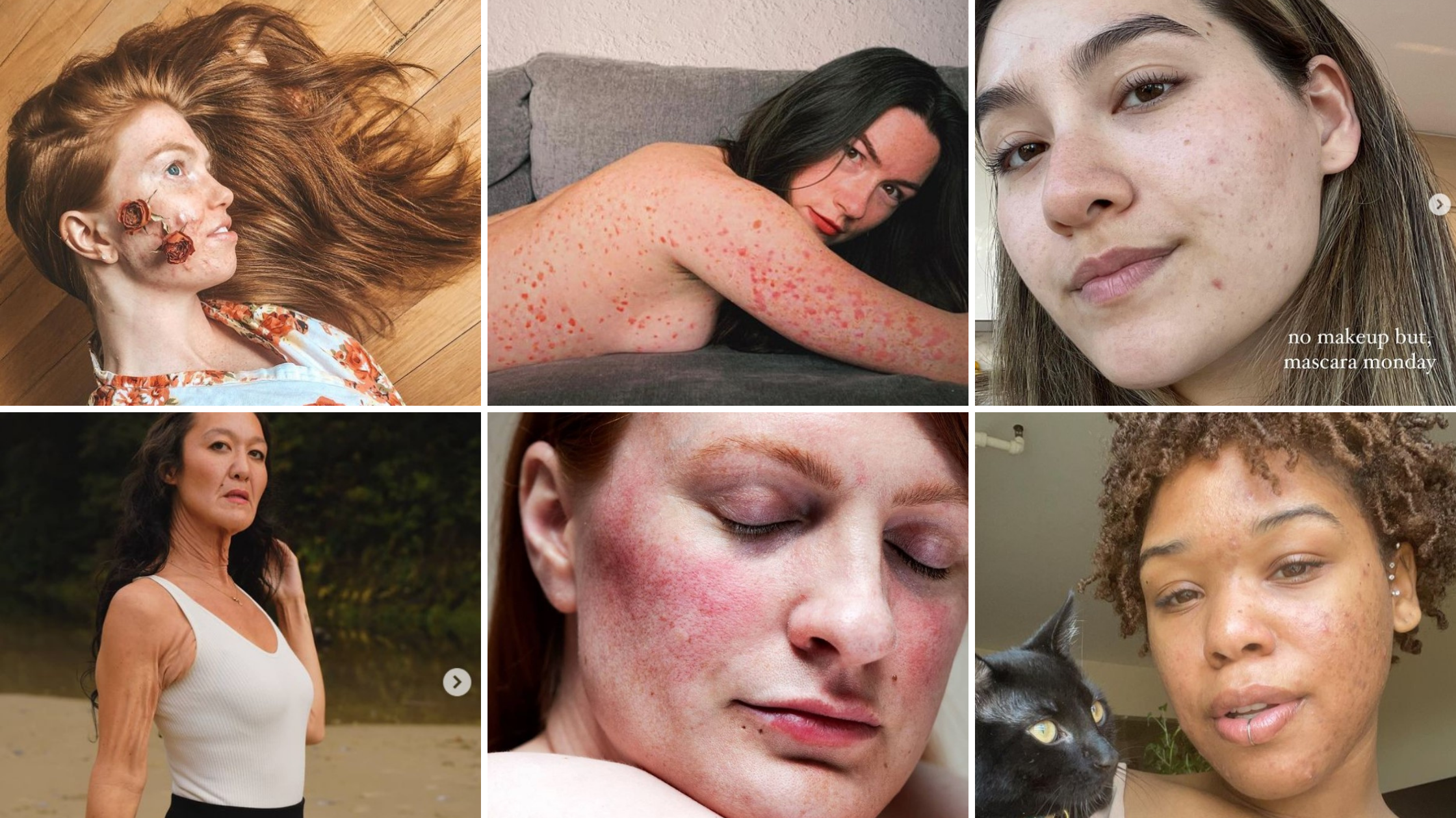 SKIN GETS REAL WITH SOCIAL MEDIA’S #SKINPOSITIVITY MOVEMENT - Sheer Miracle