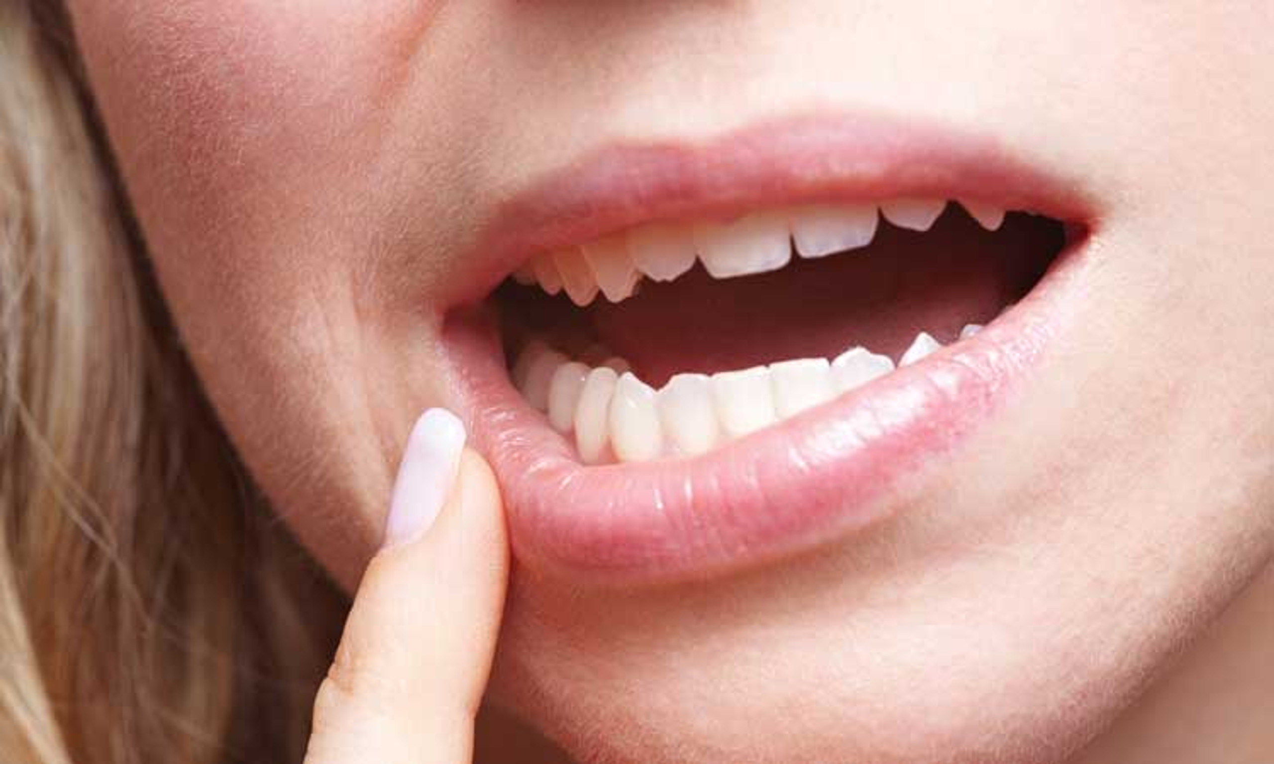 5 Natural Cures For Canker Sores Simple Girl