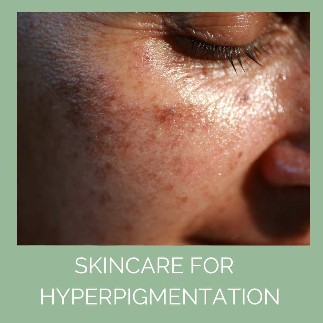 What is Hyperpigmentation? SPF and other Natural Skincare Solutions ...