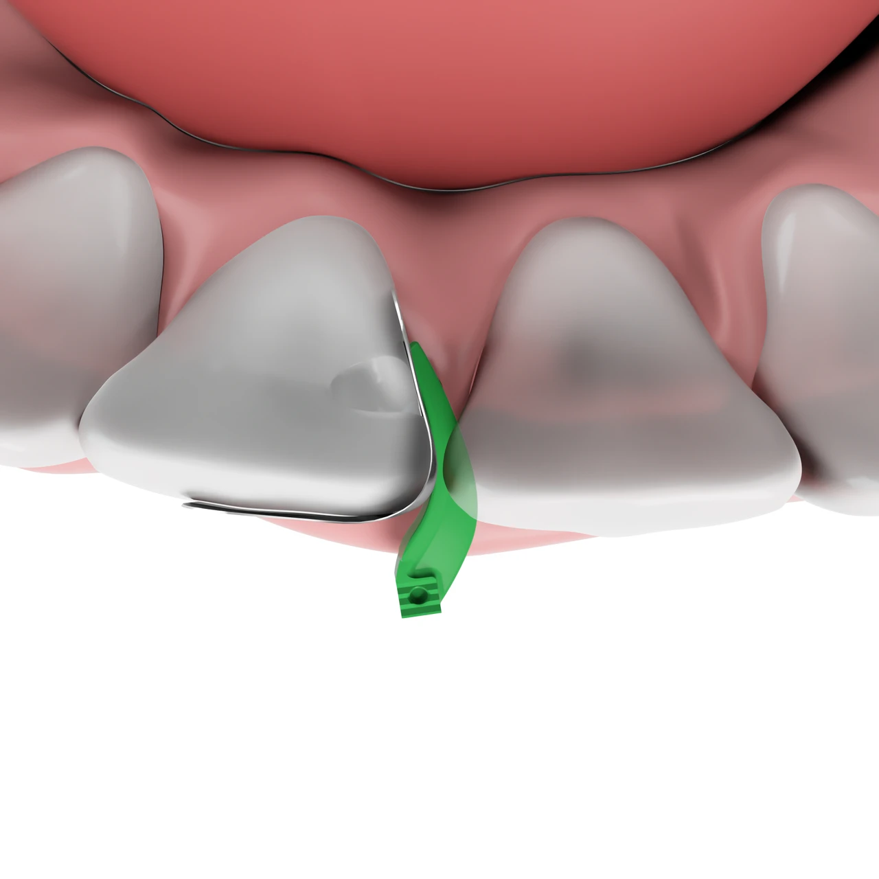 Fusion Wedge 50 Refills | Erskine Dental