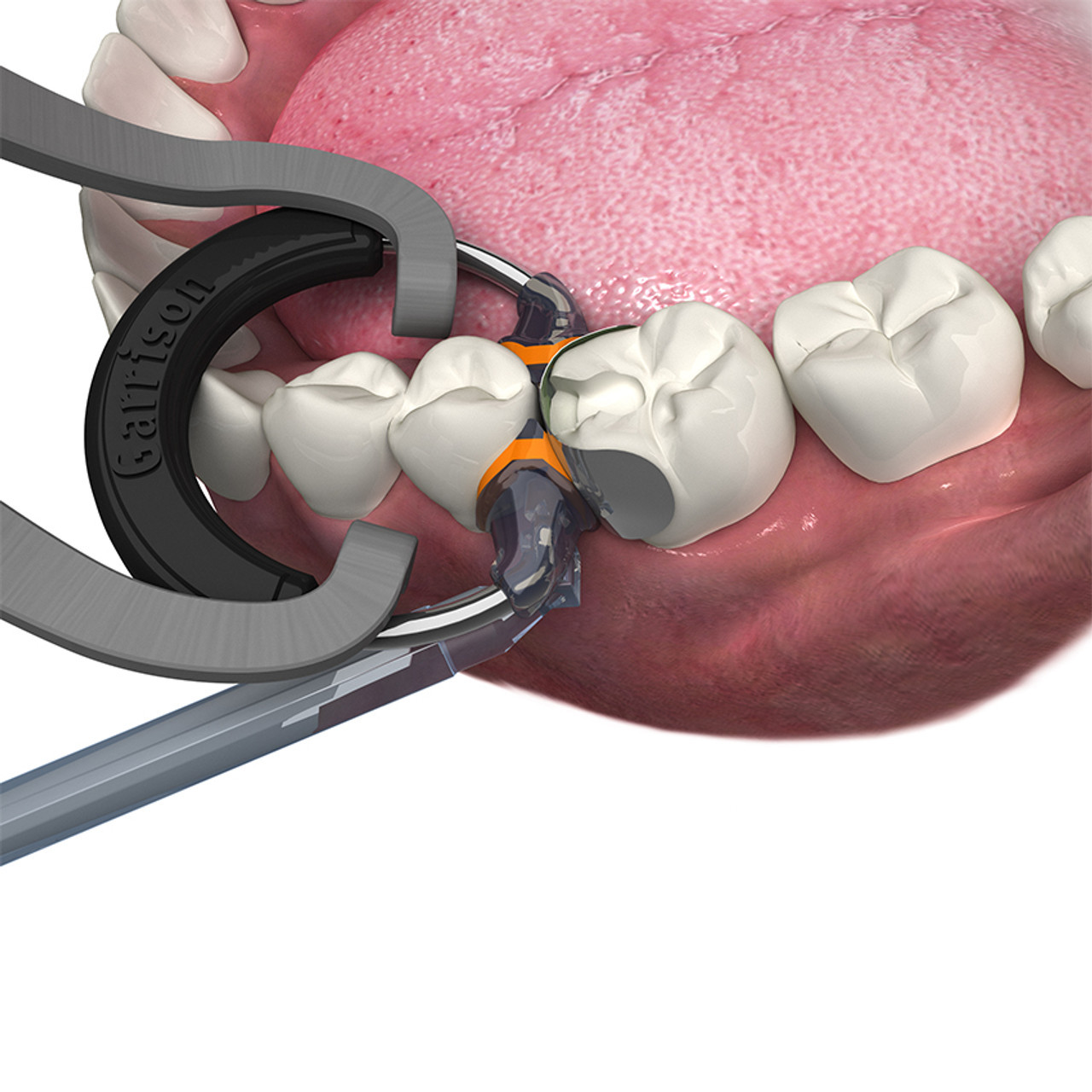 Composi Tight 3d Fusion Full Curve Bands With Ext 60 And 100 Packs