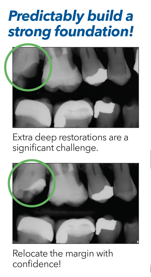 Deep Margin Elevation Kit | Erskine Dental