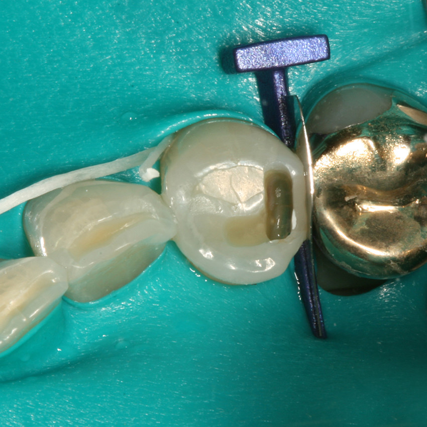 FenderWedge Tooth Shield Kit | Erskine Dental