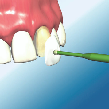 Micro-Stix Original Blue - 64 pack - Erskine Dental - Trusted Dental ...