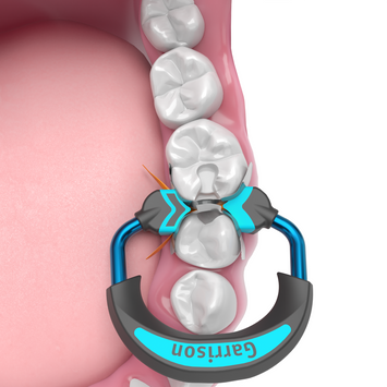Quad Sectional Matrix System - Deluxe Kit - Erskine Dental - Trusted ...