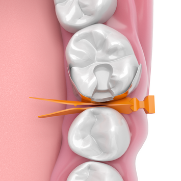 Quad Sectional Matrix Deluxe Kit | Erskine Dental