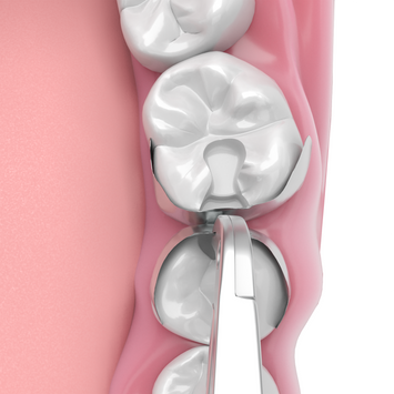 Quad Sectional Matrix System - Deluxe Kit - Erskine Dental - Trusted ...