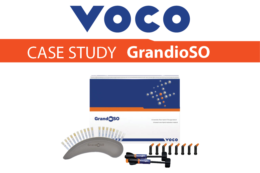 Case Study: VOCO GrandioSO - Dr. Clarance Tam - Erskine Dental ...