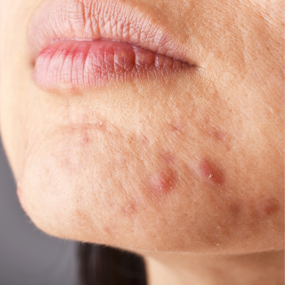 What Causes Chin Breakouts? Discover the Best Solution with Zulfees ...