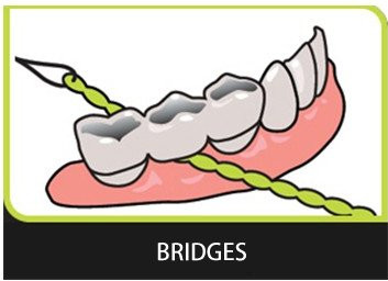 Idontix X-Floss Lite Easy Bridge and Implant Floss