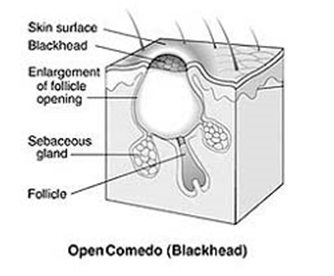 Why does my skin break out? - Skin Blends
