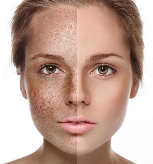 Hot Weather Skin - Tips to Fix Those Troublesome Issues - Platinum Skin ...