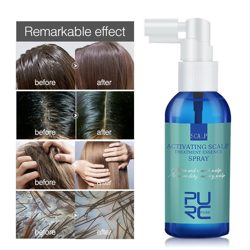 Say Goodbye to Dandruff with Anti-Dandruff Spray 60ml - Keratin ...