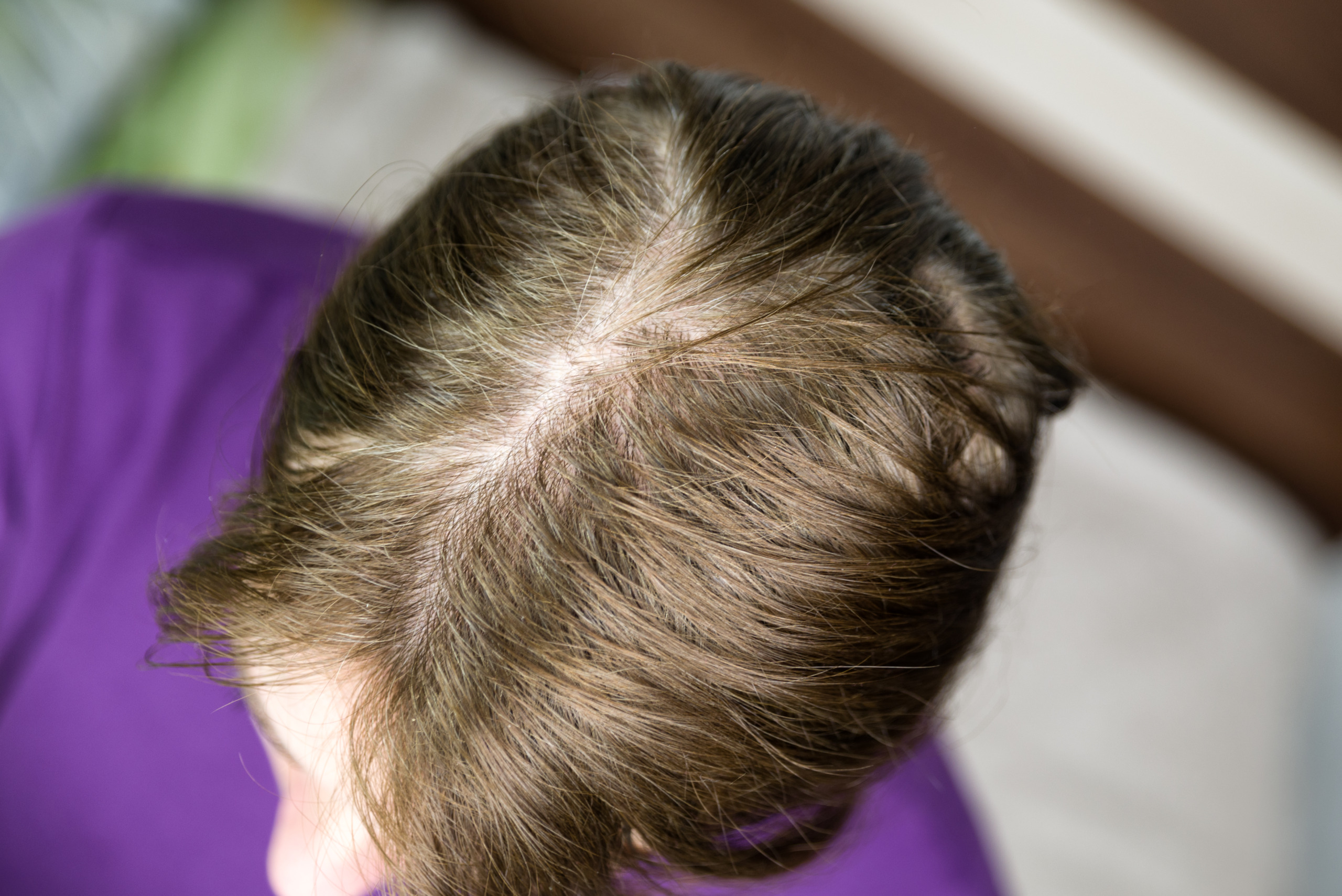 Why is my hair so thin I can see my scalp? - Keratin Treatment ...