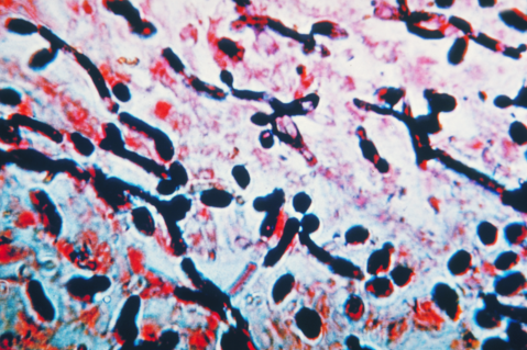 Candidoza bucala (infectia cu candida) - cauze, simptome, tratament ...