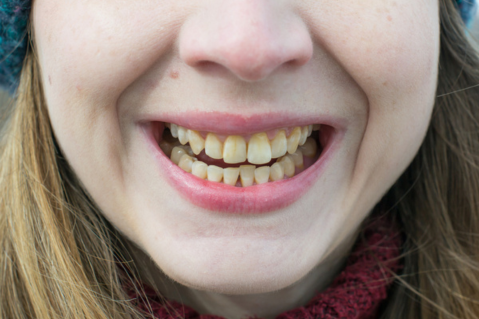 Fluoroza dentară la copii - cauze, tratament, prevenție - Dentamerica ...