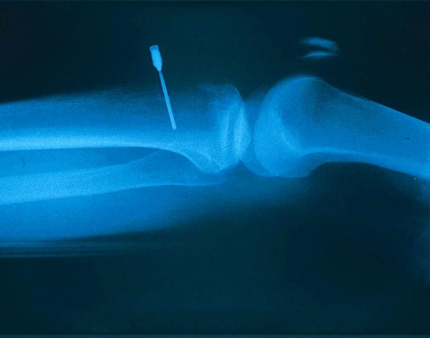 B.I.G. Bone Injection Gun - Adult | Live Action Safety