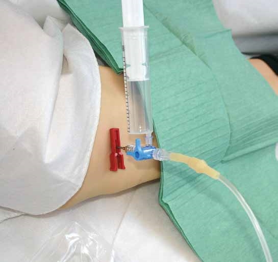 B.I.G. Bone Injection Gun - Pediatric | Live Action Safety