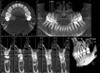 Planmeca ProMax 3D Classic | Extraoral Bitewings | Renew Digital