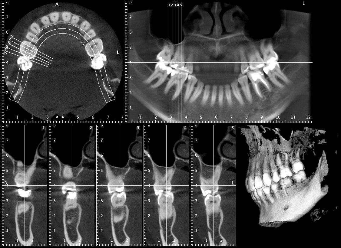 Planmeca ProMax 3D Pano + Cone Beam + Ceph | Renew Digital