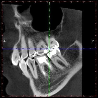 Planmeca ProMax 3D Pano + Cone Beam + Ceph | Renew Digital
