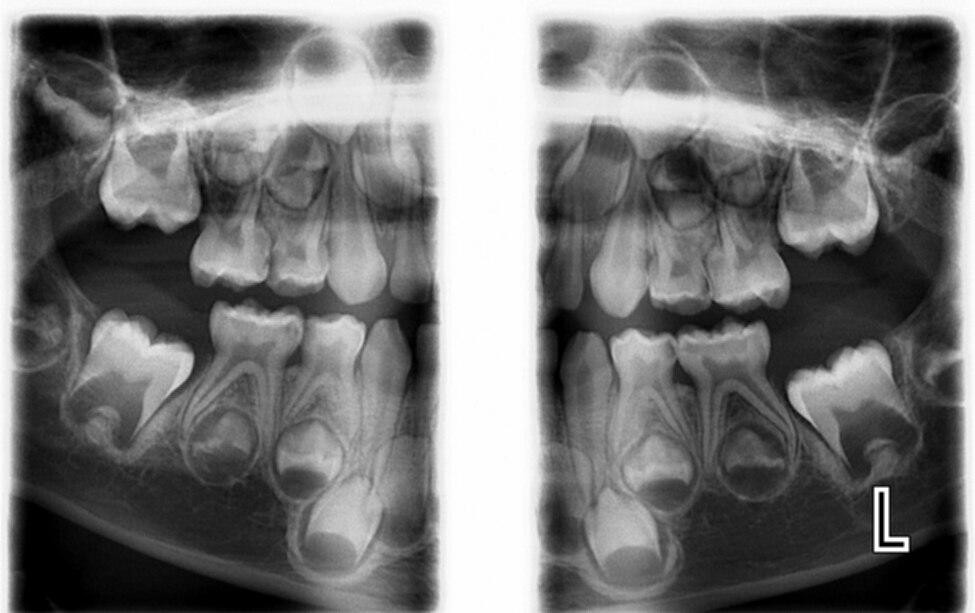 Planmeca ProMax 3D Classic | Extraoral Bitewings | Renew Digital