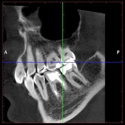 Planmeca ProMax 3D Classic | Extraoral Bitewings | Renew Digital