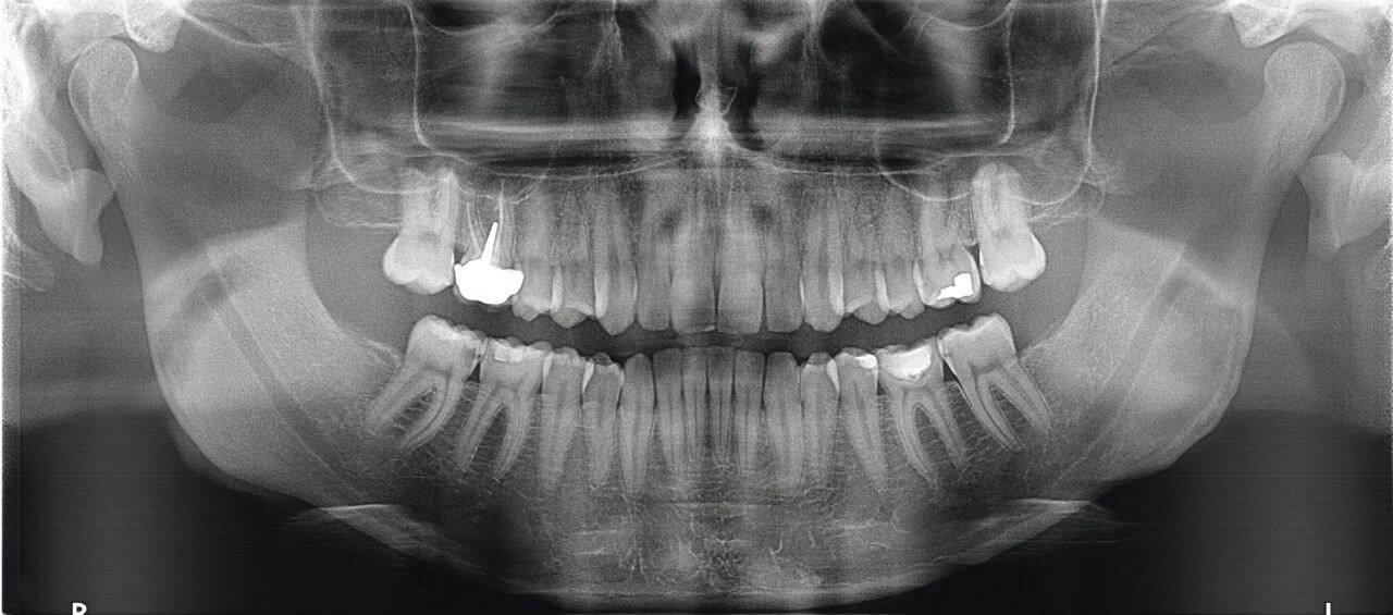 Buy Carestream Cs 8100 Panorex Online | Renew Digital