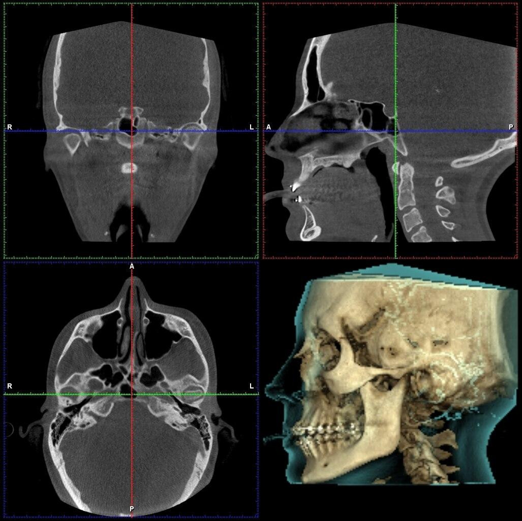 Planmeca ProMax 3D Mid Pano + Cone Beam | Renew Digital