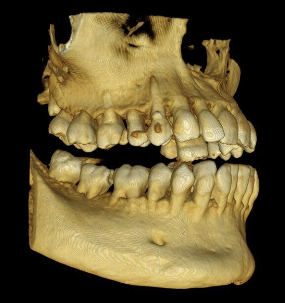 Carestream CS 8100 3D Panorex + Cone Beam | Renew Digital