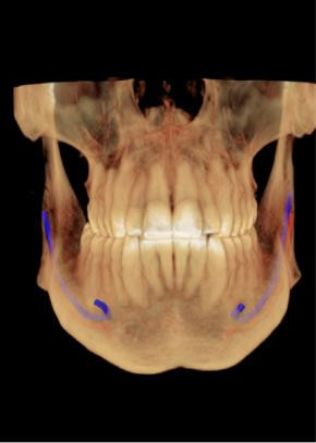 DEXIS OP 3D Panorex + Cone Beam For Sale | Renew Digital