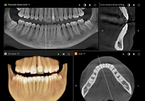 Buy DEXIS OP 3D Panorex Cone Beam Online | Renew Digital