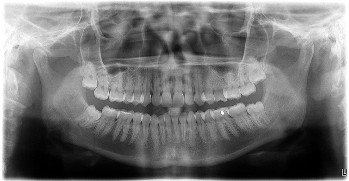 DEXIS OP 3D Panorex + Cone Beam For Sale | Renew Digital