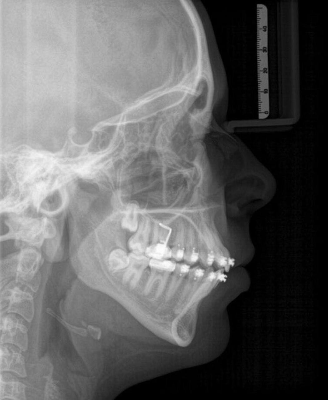 Sirona Orthophos SL 3D Panorex + Cone Beam For Sale | Renew Digital