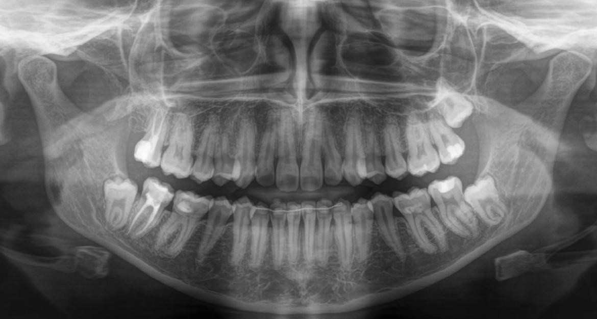 Sirona Orthophos SL 3D Panorex + Cone Beam For Sale | Renew Digital